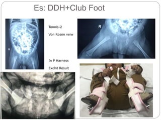 2 ddh principles & protocols of rx. 0 12 m age | PPT
