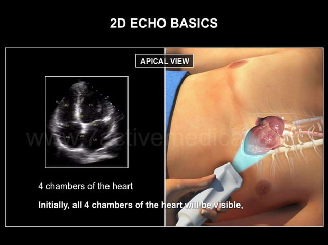 2d Echo Basics | PPTX | Technology & Computing
