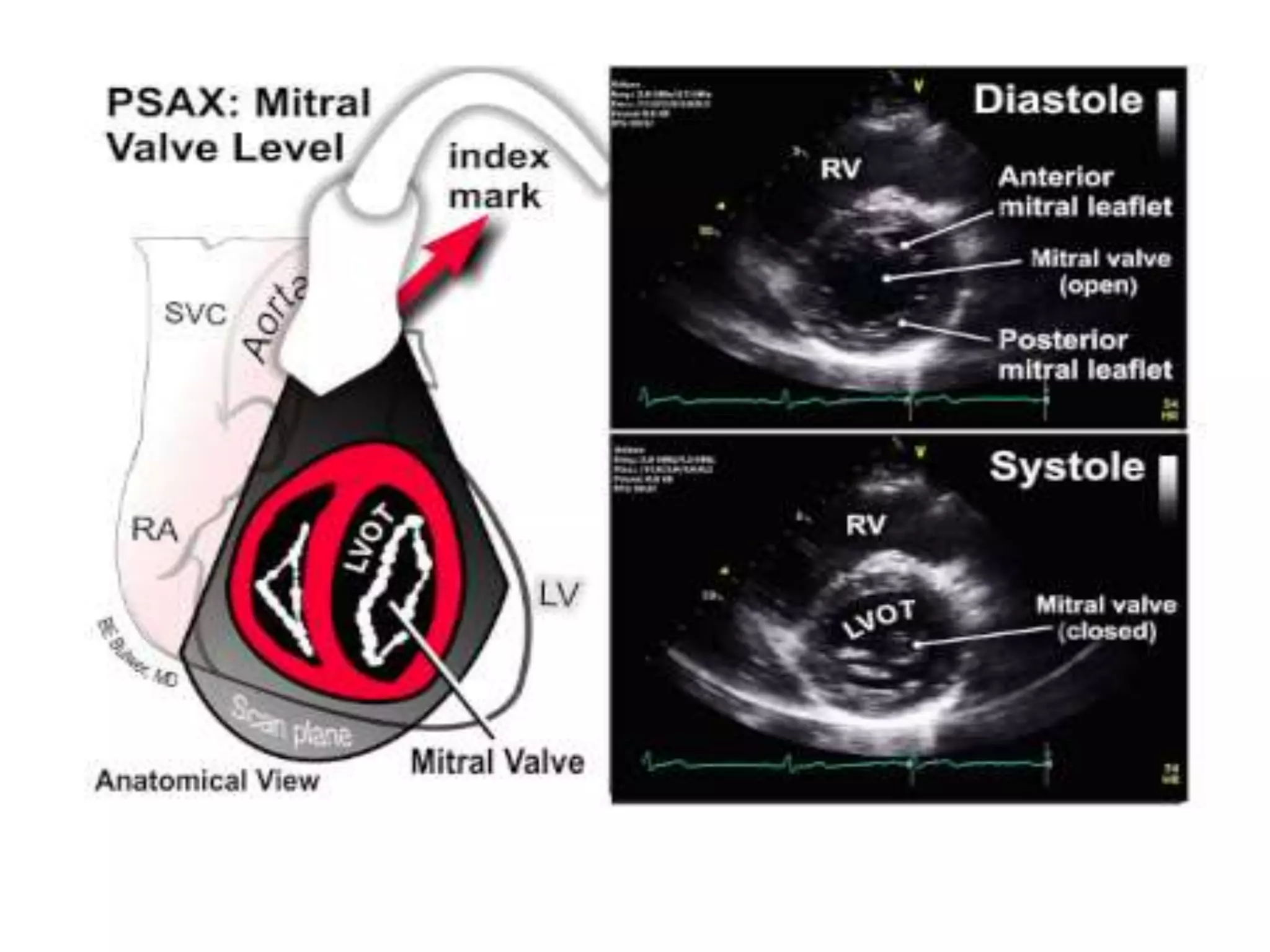 2 d echocardiography views | PPTX | Digital Audio | Computer Software ...