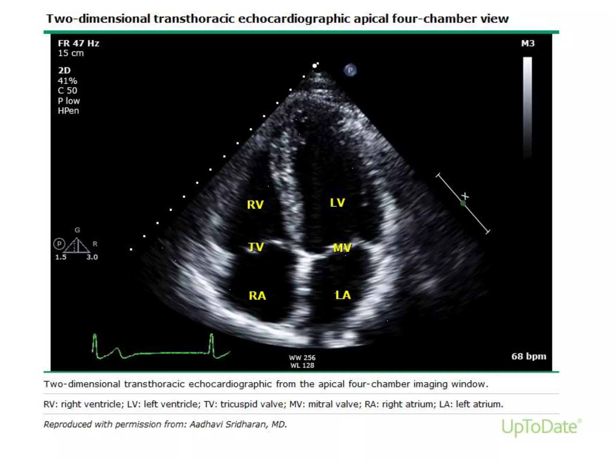 2 d echocardiography views | PPT