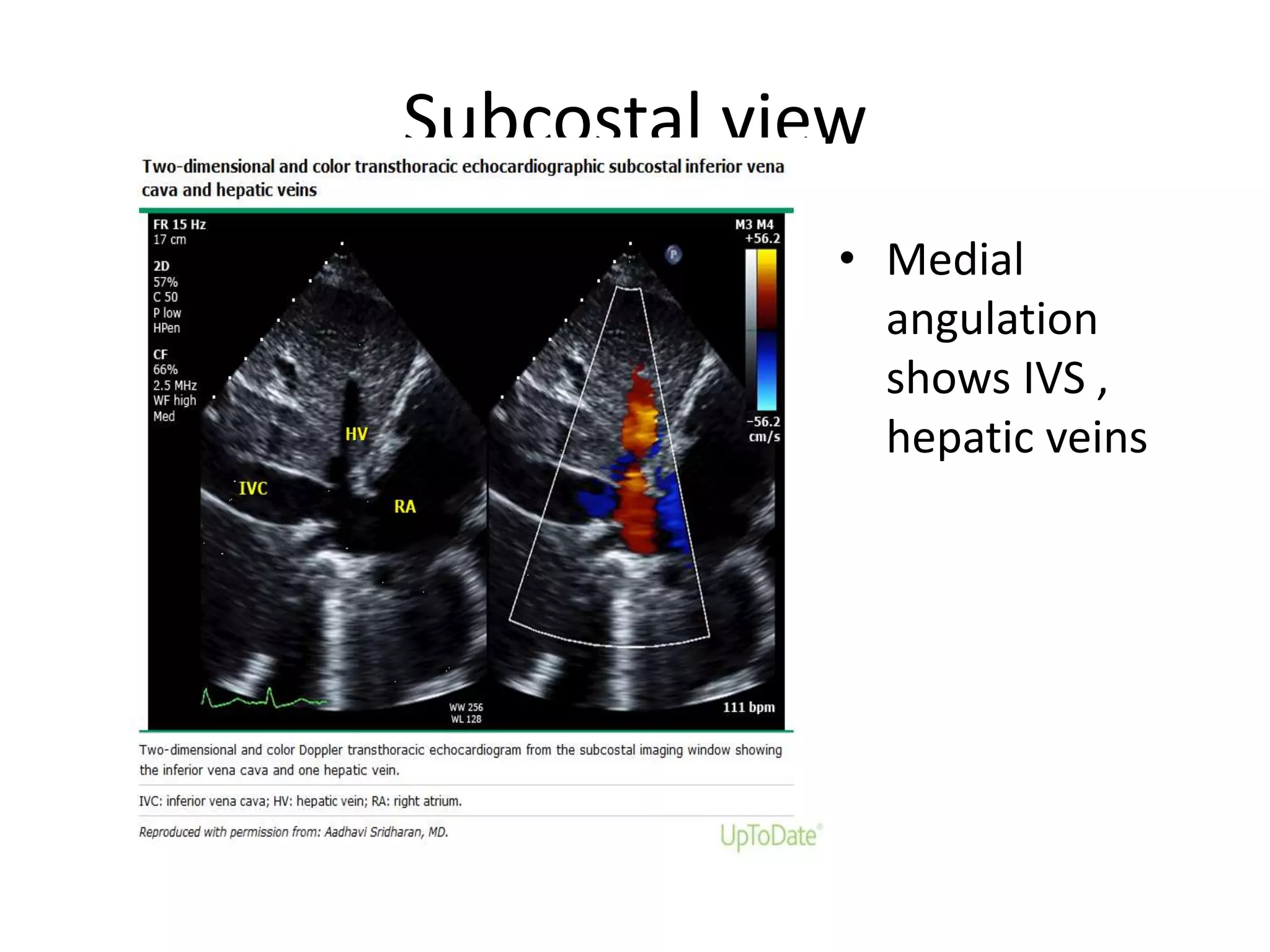 2 d echocardiography views | PPTX | Digital Audio | Computer Software ...