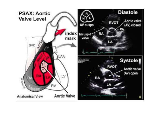 2 d echocardiography views | PPTX | Digital Audio | Computer Software ...