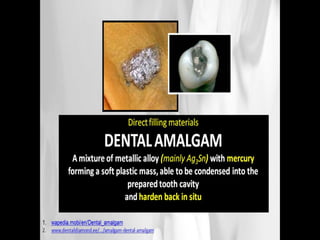 dental amalgam dental material | PPT