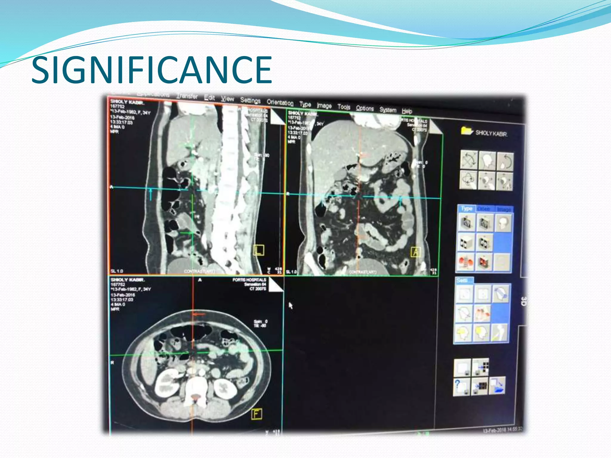 COMPUTED TOMOGRAPHY SCAN | PPTX