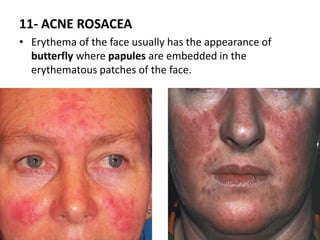 Sweat Glands Infection