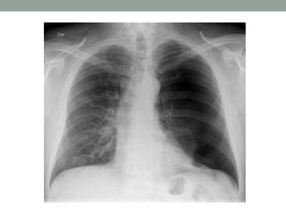 Radiografía de torax.pptx