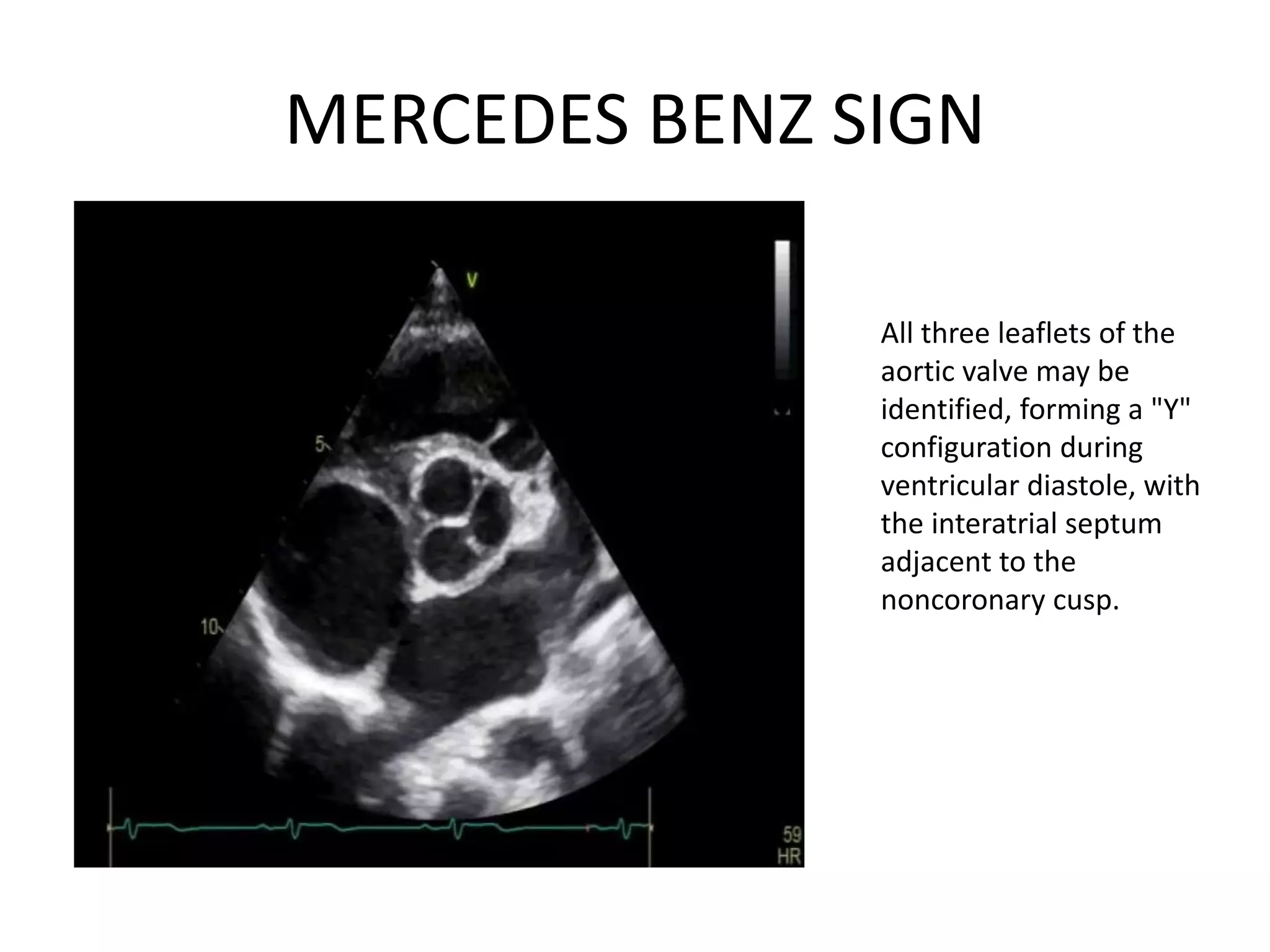 2d Transthoracic Echocardiographic views | PPT