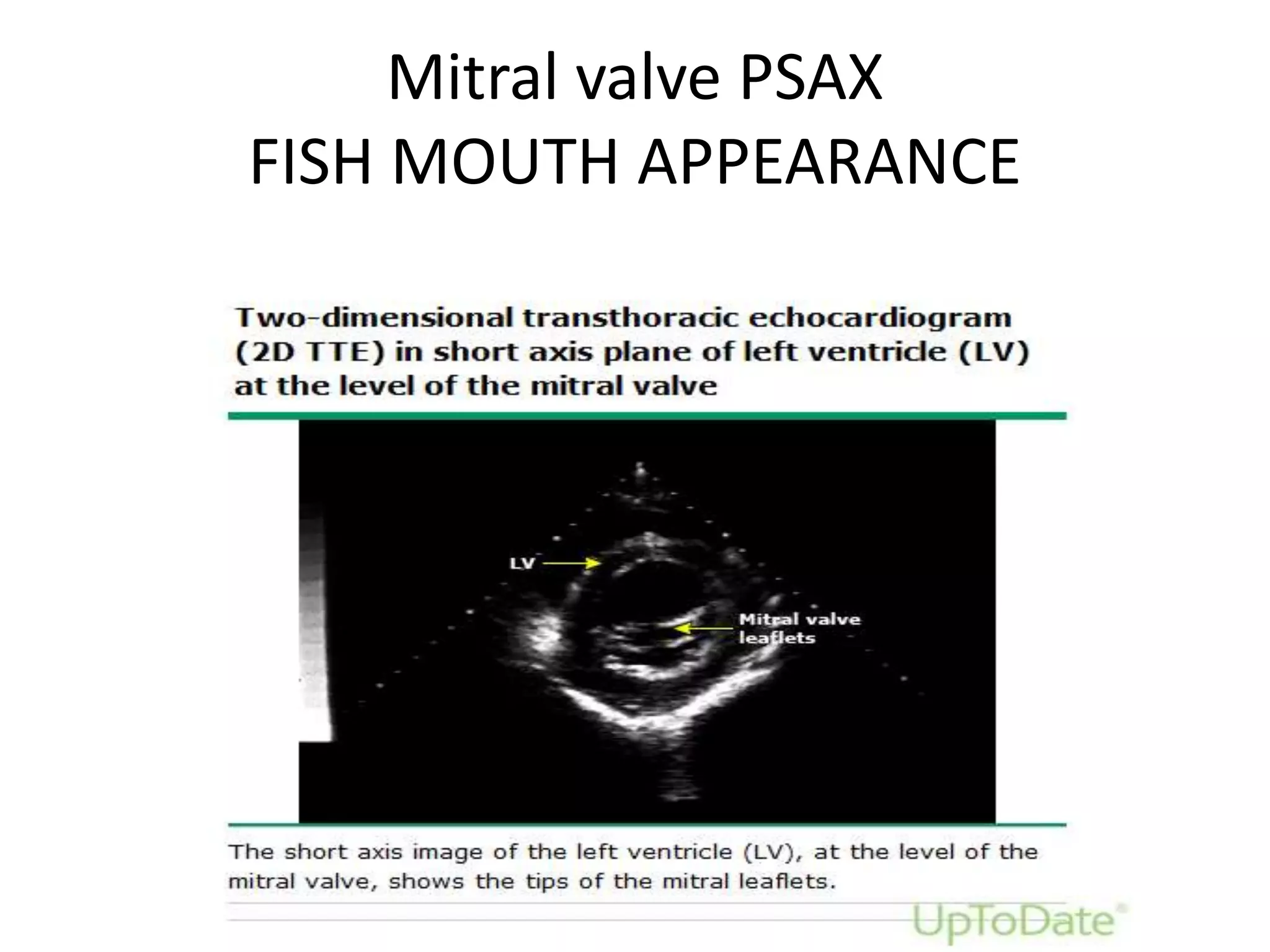 2d Transthoracic Echocardiographic views | PPT