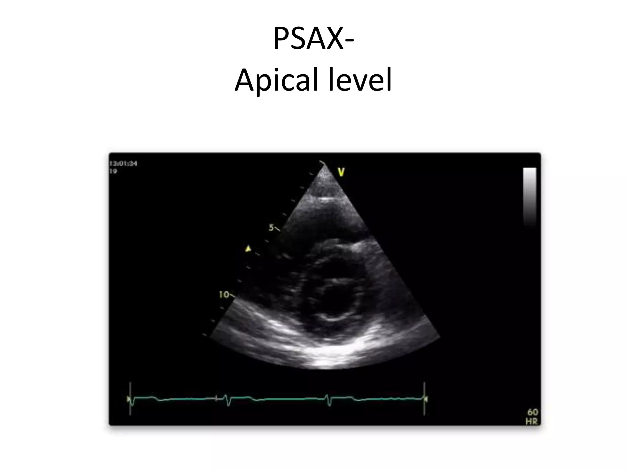 2d Transthoracic Echocardiographic views | PPT