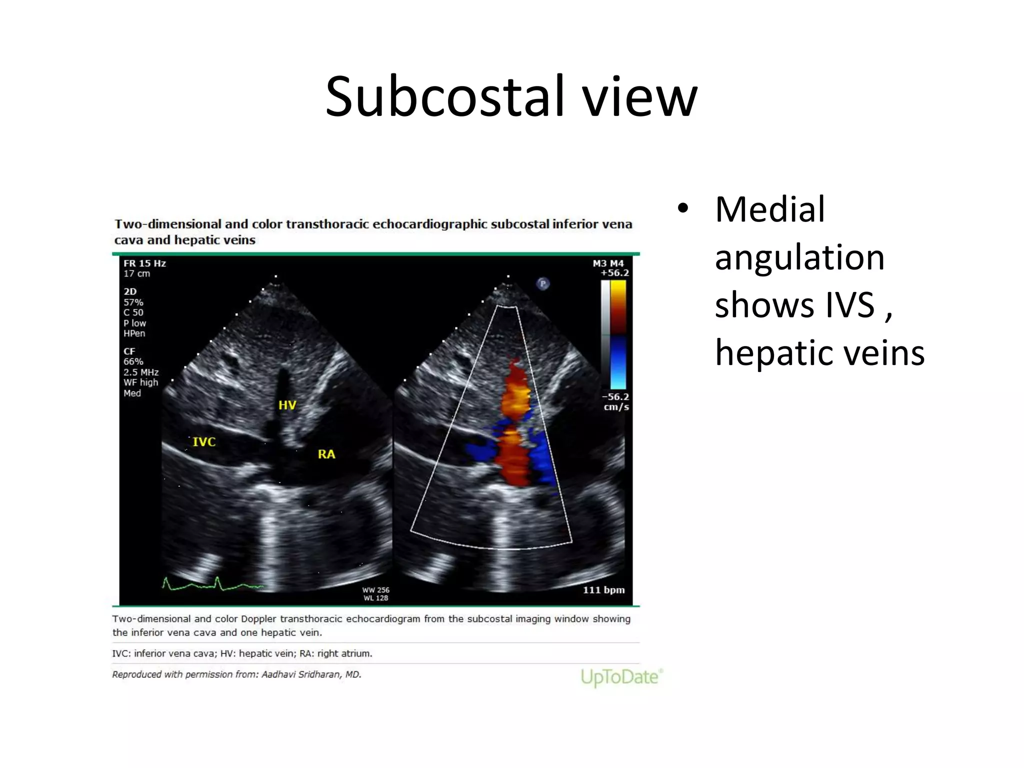 2d Transthoracic Echocardiographic views | PPT