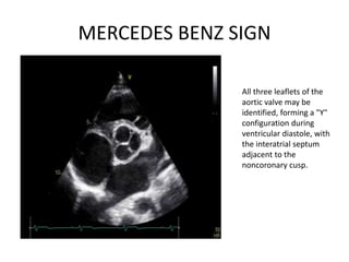 2d Transthoracic Echocardiographic views | PPT