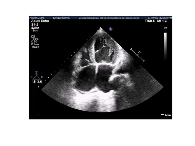 2d Transthoracic Echocardiographic views | PPT | Death, Injury, or ...