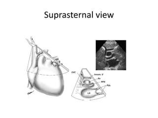 2d Transthoracic Echocardiographic views | PPT