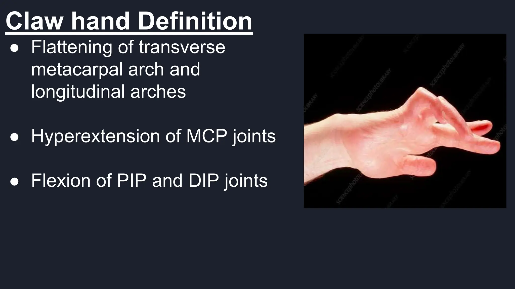 Ulnar_nerve_palsy_and_Tendon_transfer.pptx