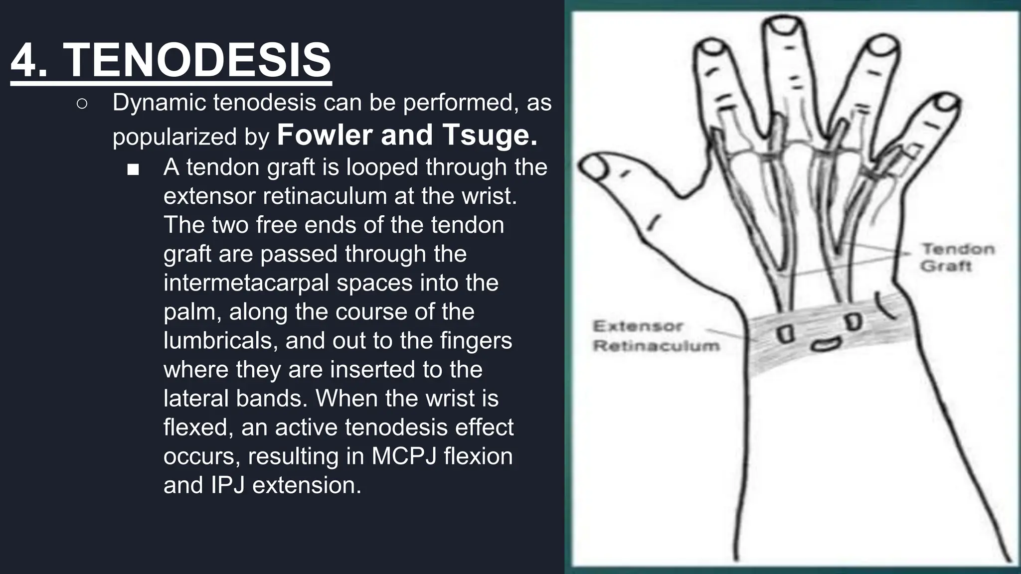 Ulnar_nerve_palsy_and_Tendon_transfer.pptx