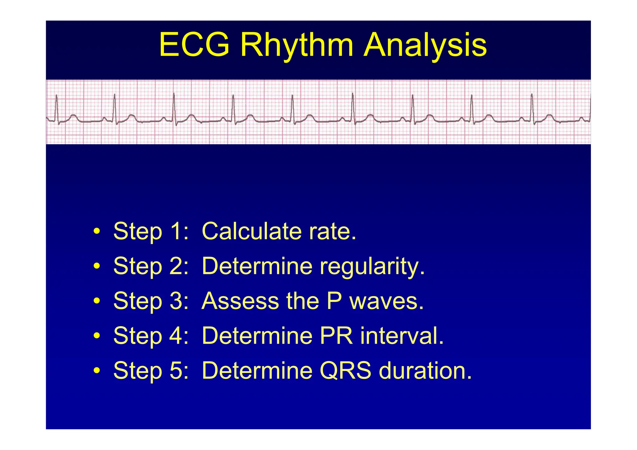 ECG Rhythm Interpretation (ECG Rhythm Analysis) | PDF