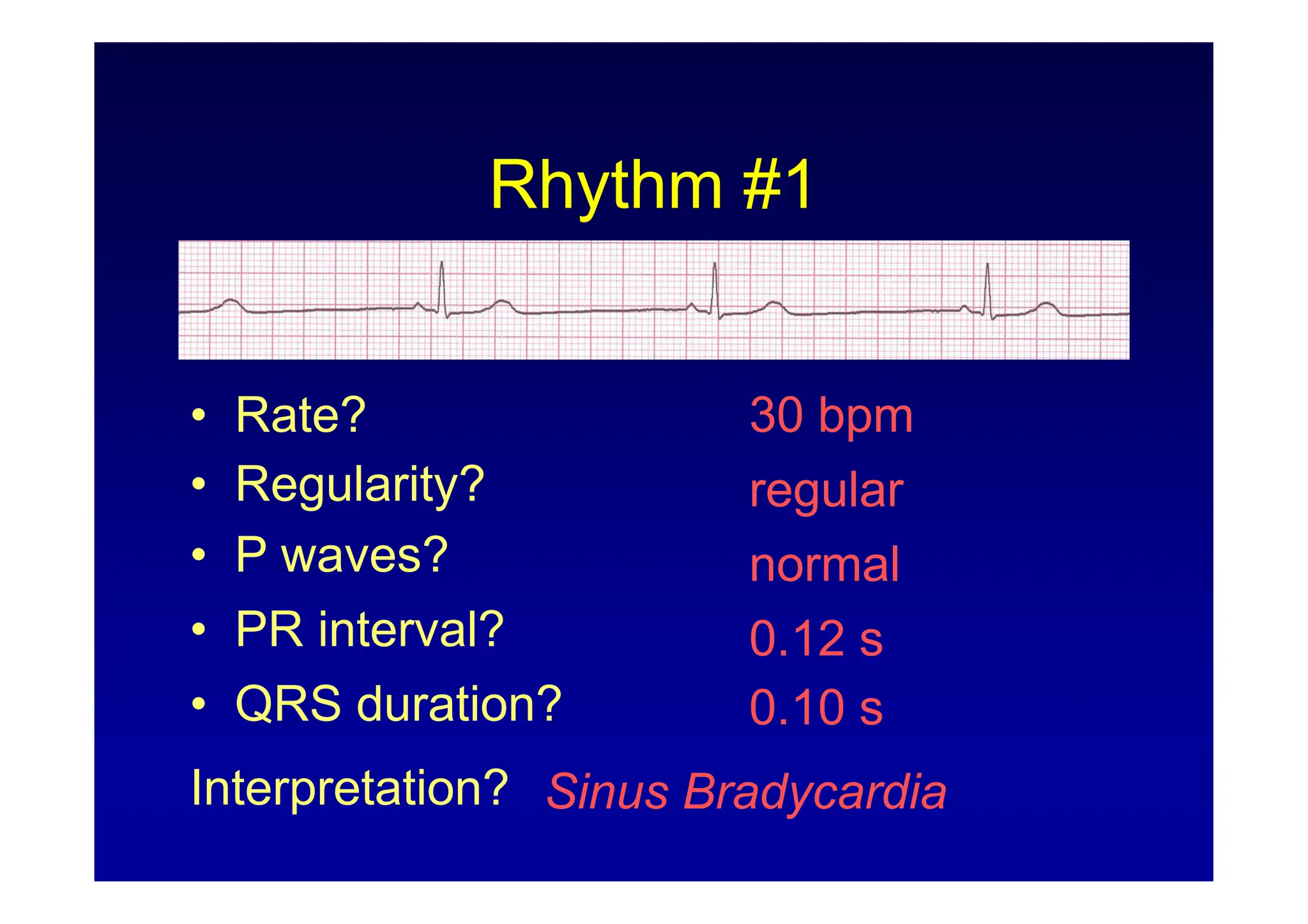 ECG Rhythm Interpretation (ECG Rhythm Analysis) | PDF