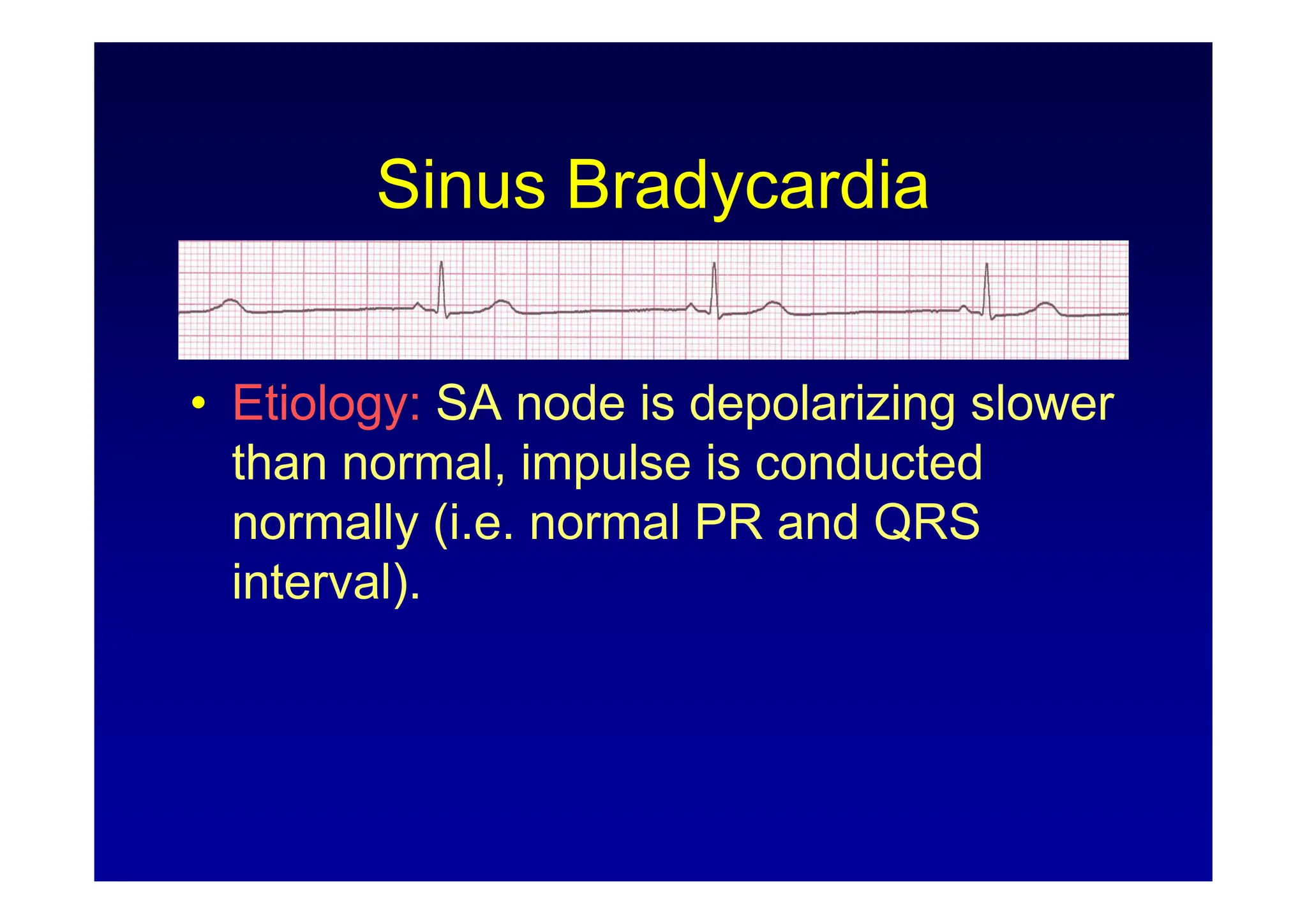ECG Rhythm Interpretation (ECG Rhythm Analysis) | PDF