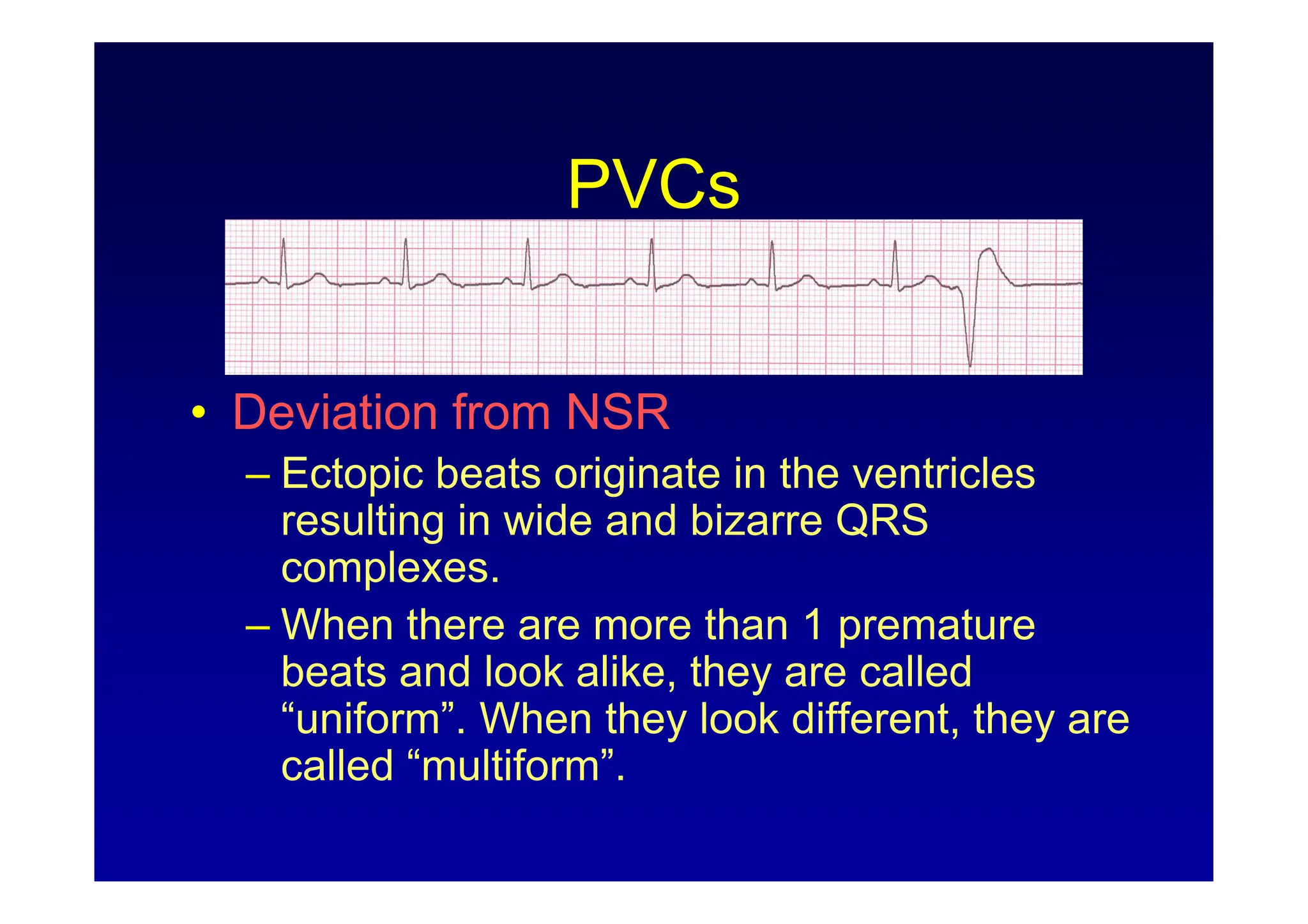 ECG Rhythm Interpretation (ECG Rhythm Analysis) | PDF