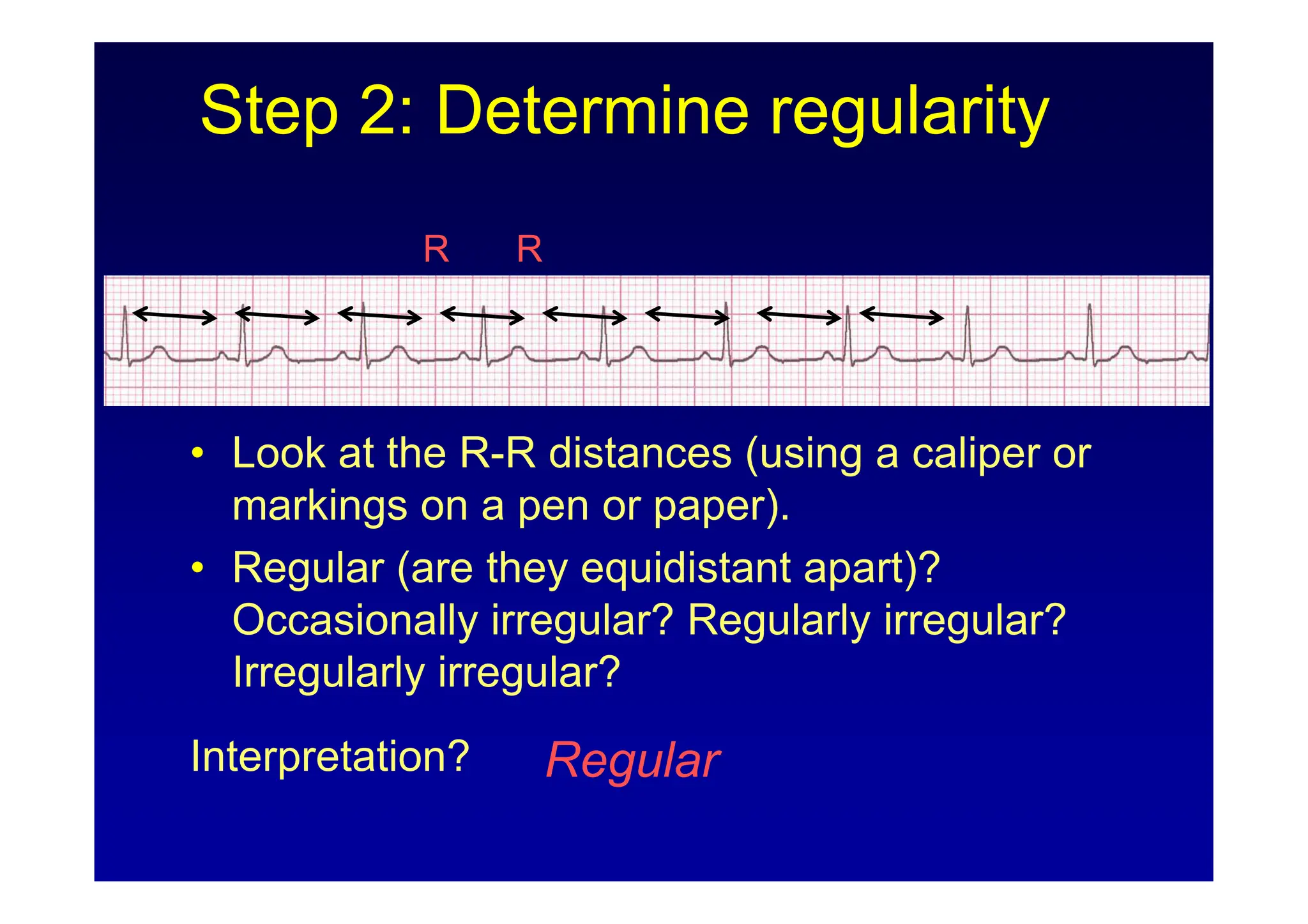 ECG Rhythm Interpretation (ECG Rhythm Analysis) | PDF