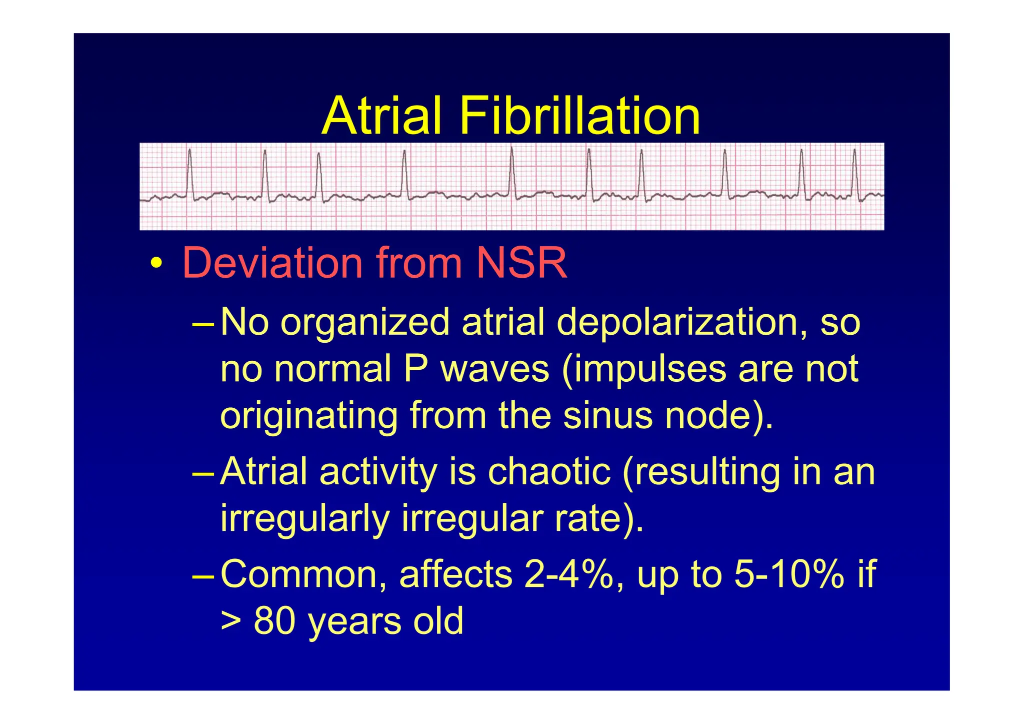 ECG Rhythm Interpretation (ECG Rhythm Analysis) | PDF