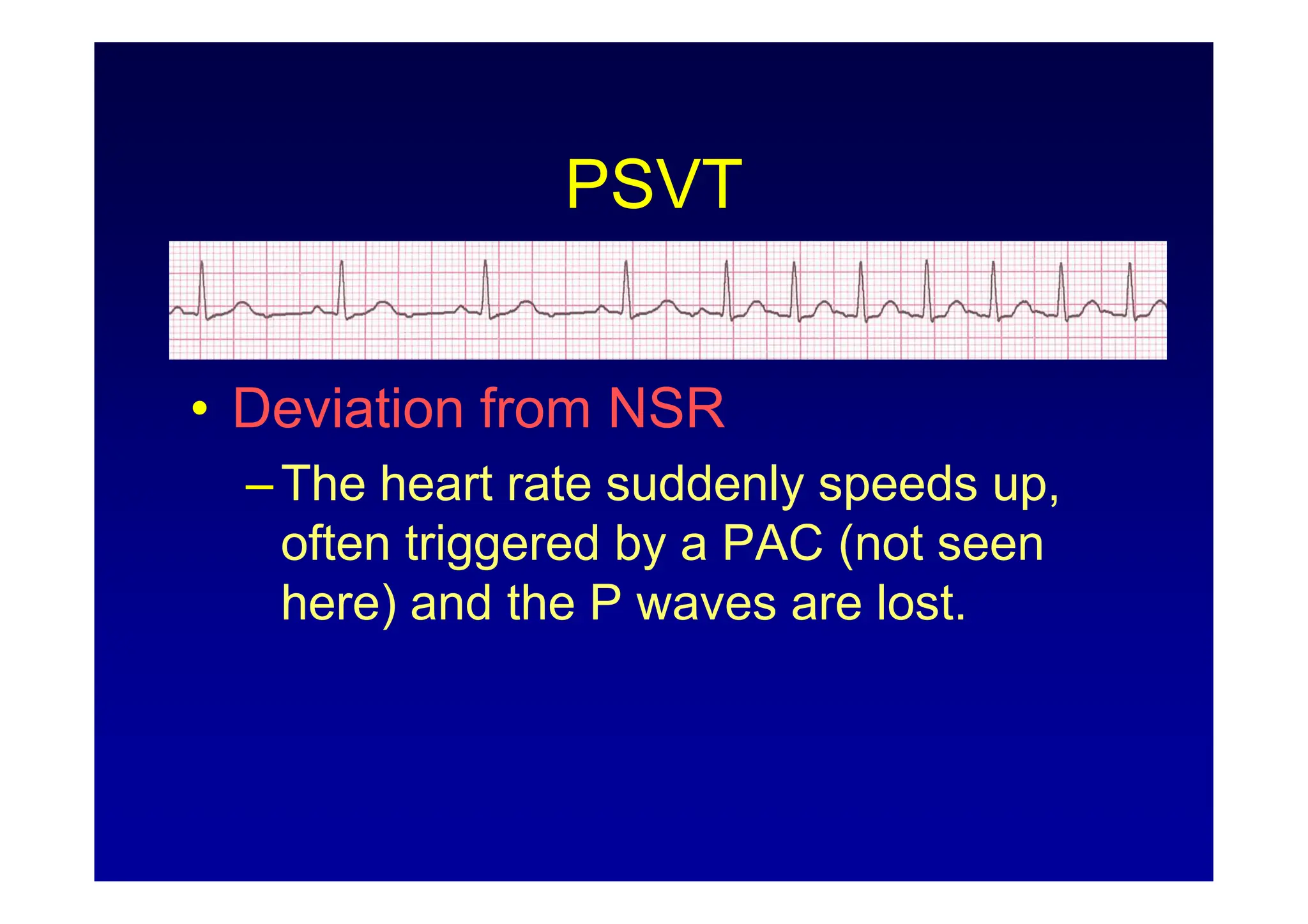ECG Rhythm Interpretation (ECG Rhythm Analysis) | PDF