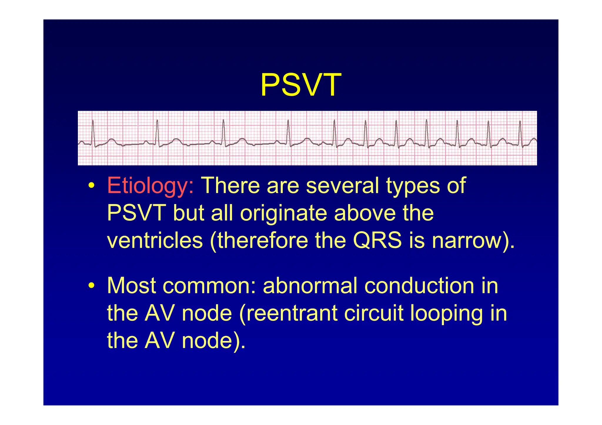 ECG Rhythm Interpretation (ECG Rhythm Analysis) | PDF