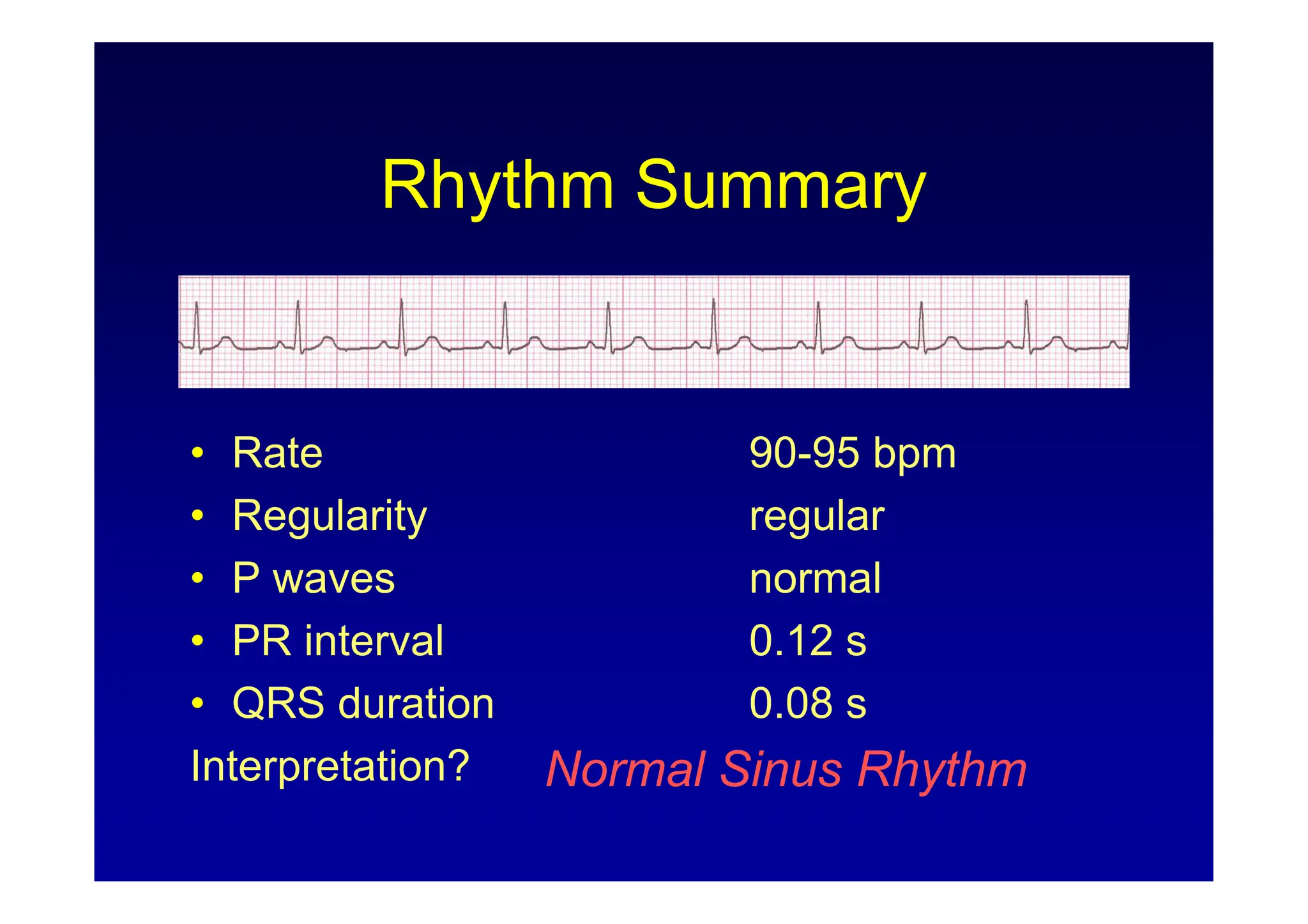 ECG Rhythm Interpretation (ECG Rhythm Analysis) | PDF