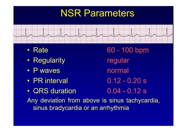 ECG Rhythm Interpretation (ECG Rhythm Analysis) | PDF