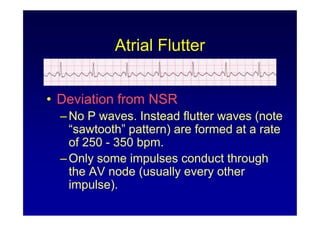 ECG Rhythm Interpretation (ECG Rhythm Analysis) | PDF