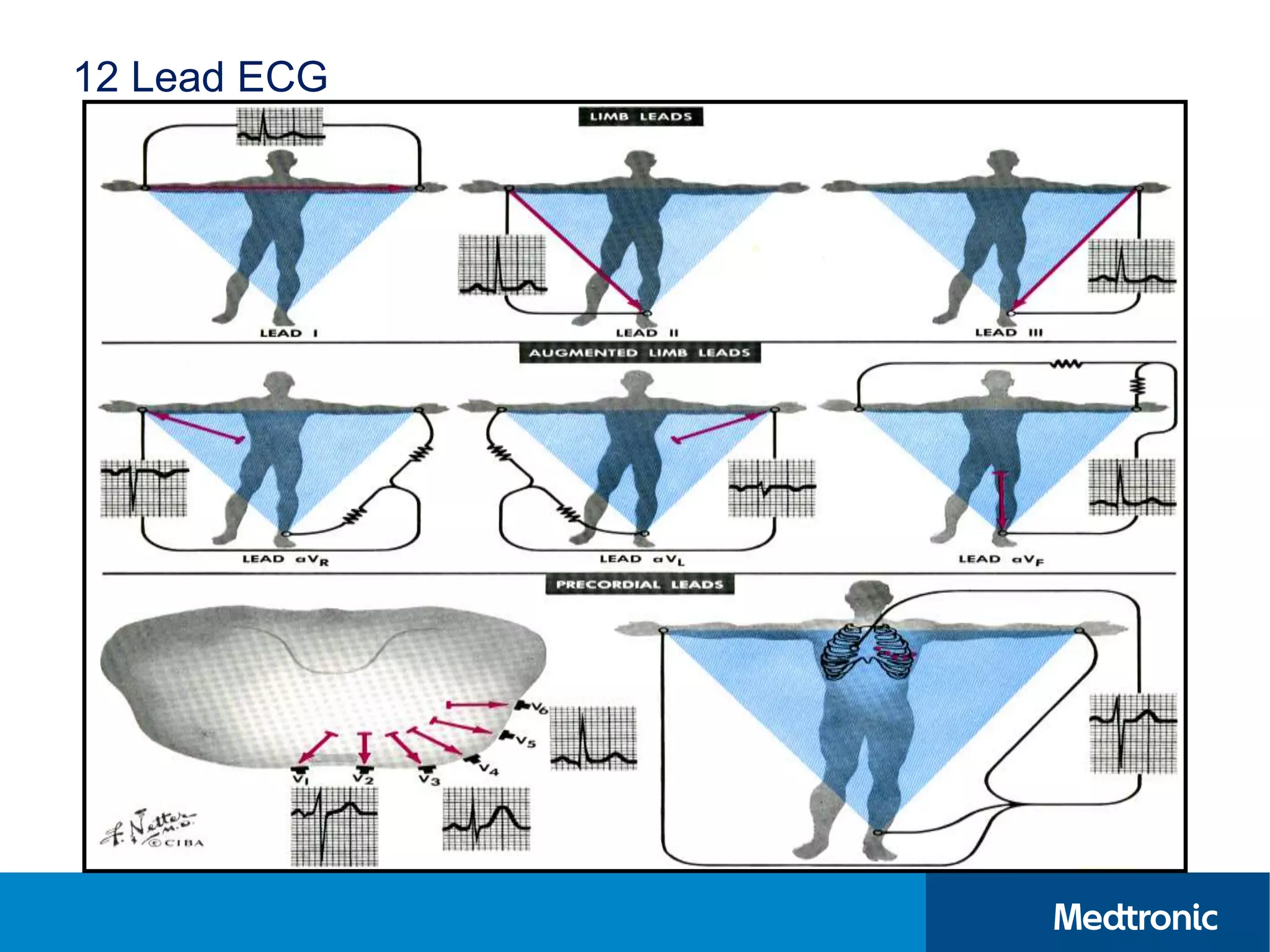 Ecg And Intro To Cardiac Arrhythmias Pptx