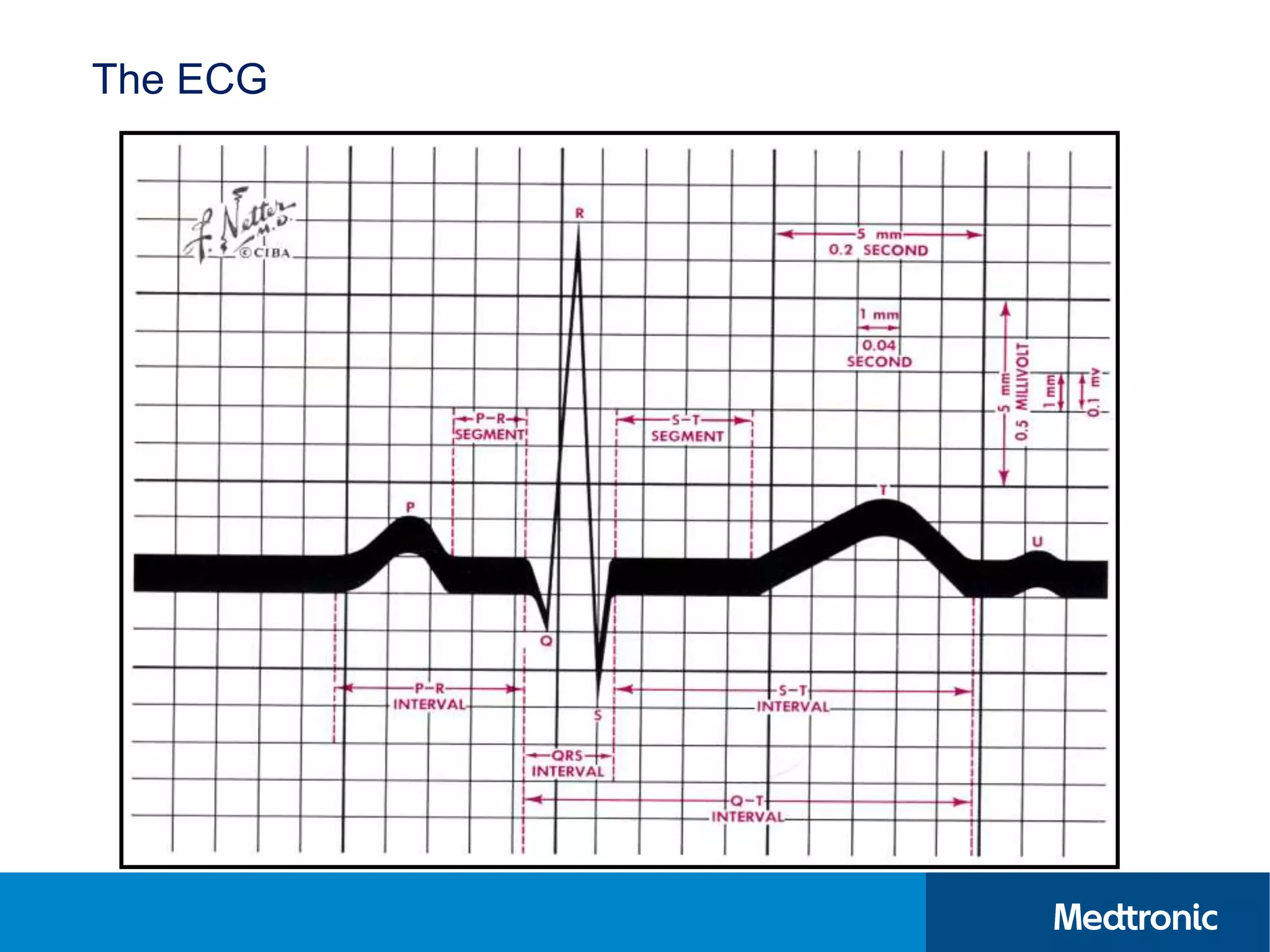ECG & Intro to Cardiac Arrhythmias.pptx
