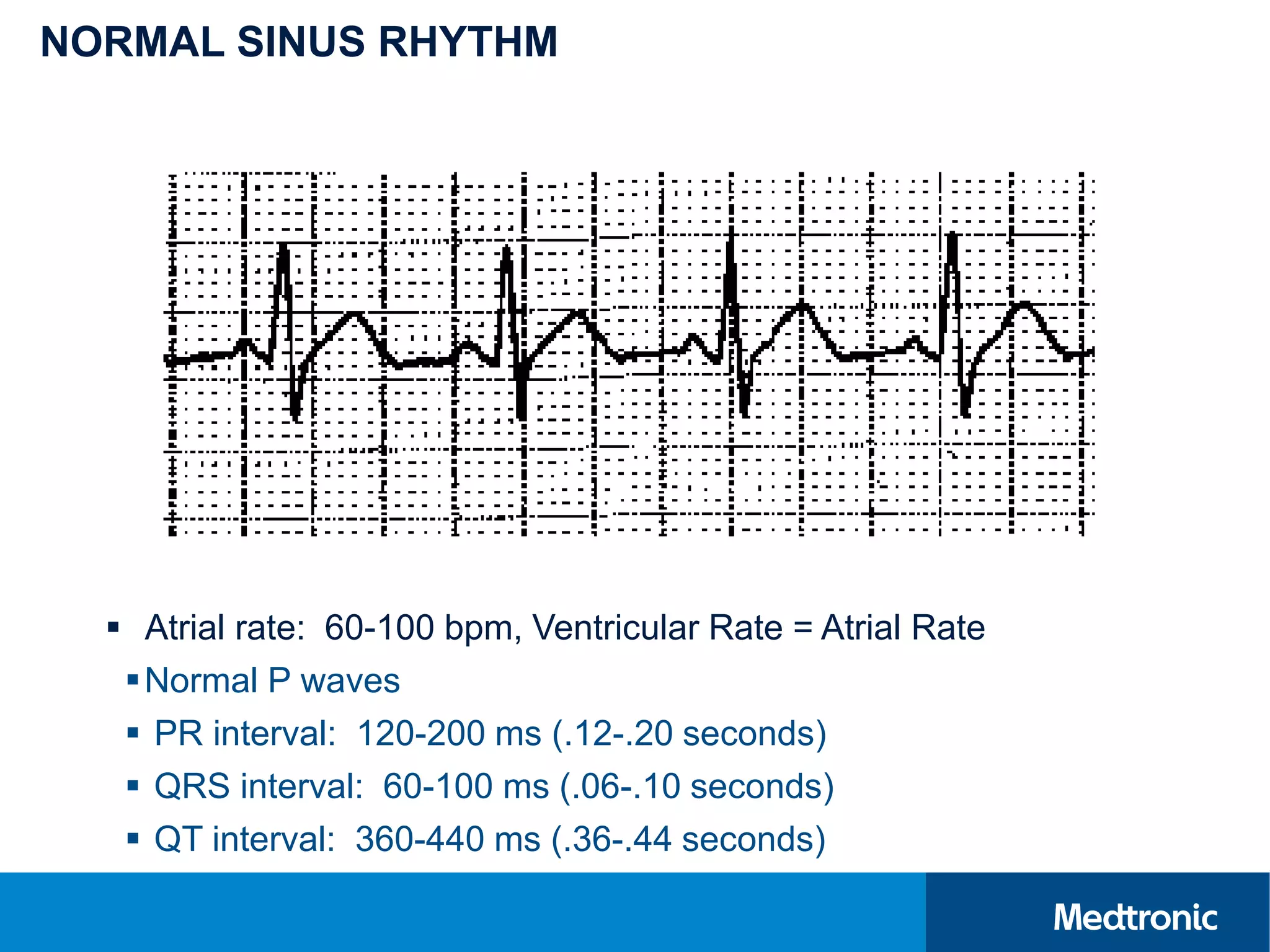 ECG & Intro to Cardiac Arrhythmias.pptx