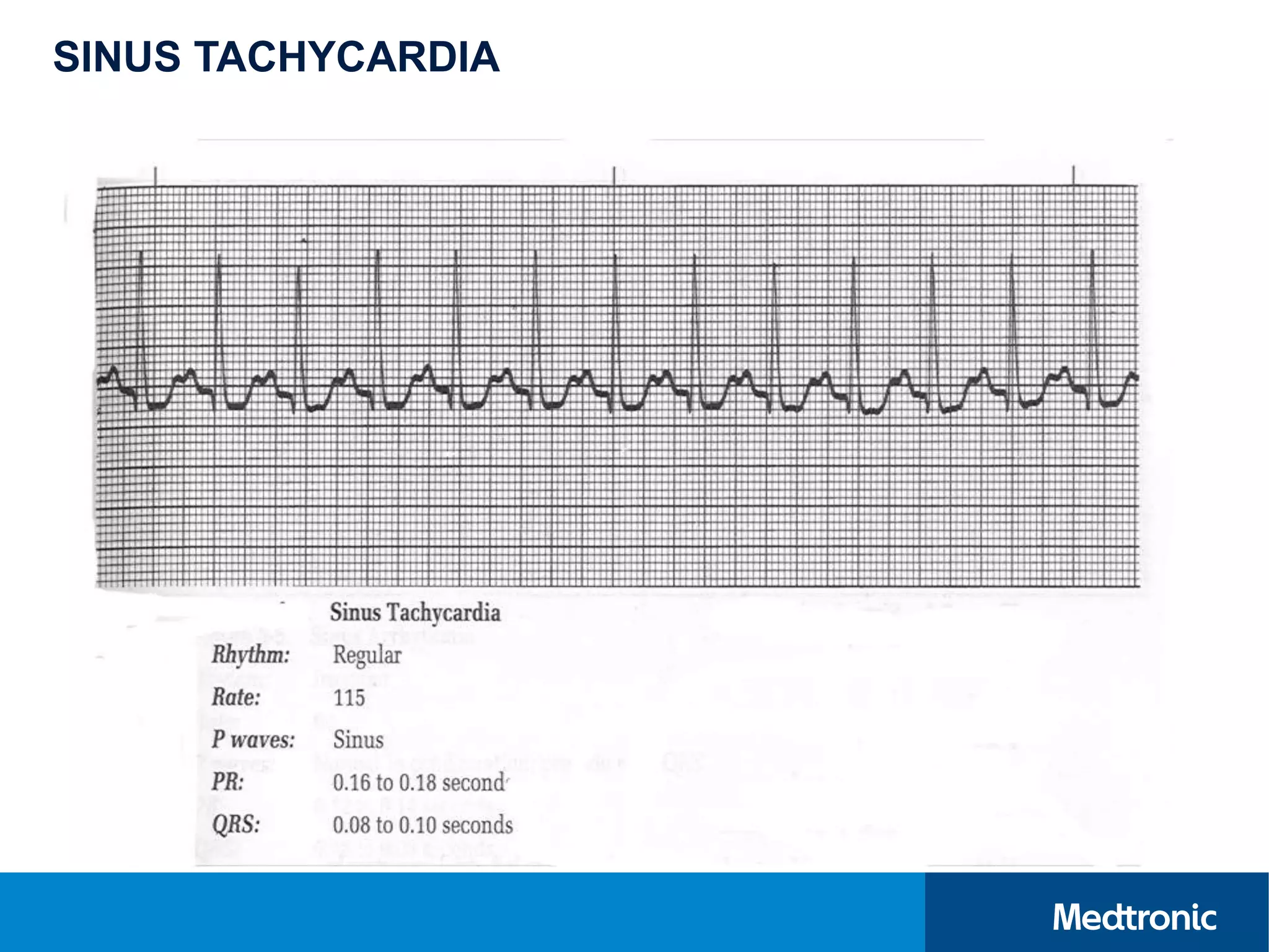 Ecg And Intro To Cardiac Arrhythmias Pptx