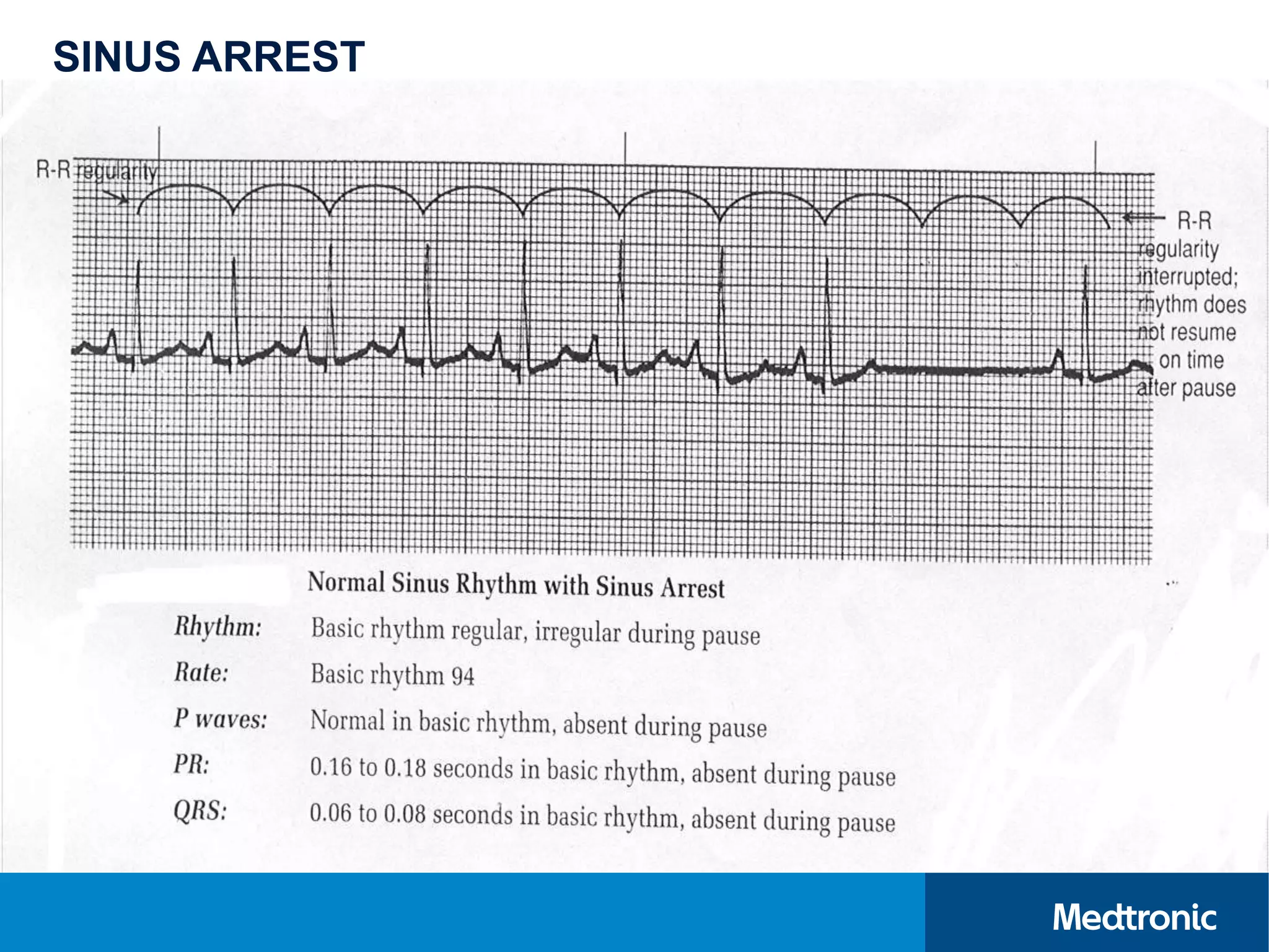 ECG & Intro to Cardiac Arrhythmias.pptx