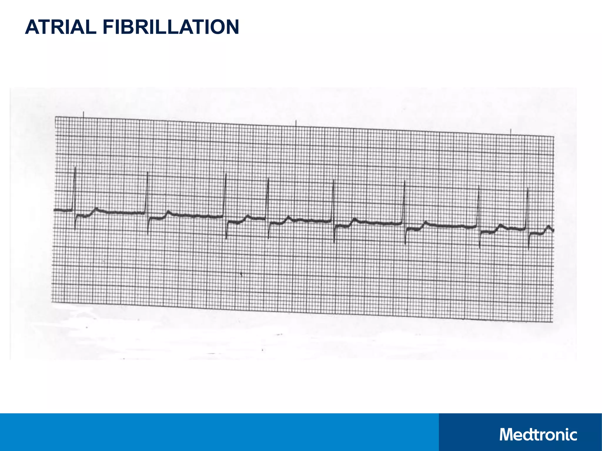 Ecg And Intro To Cardiac Arrhythmias Pptx