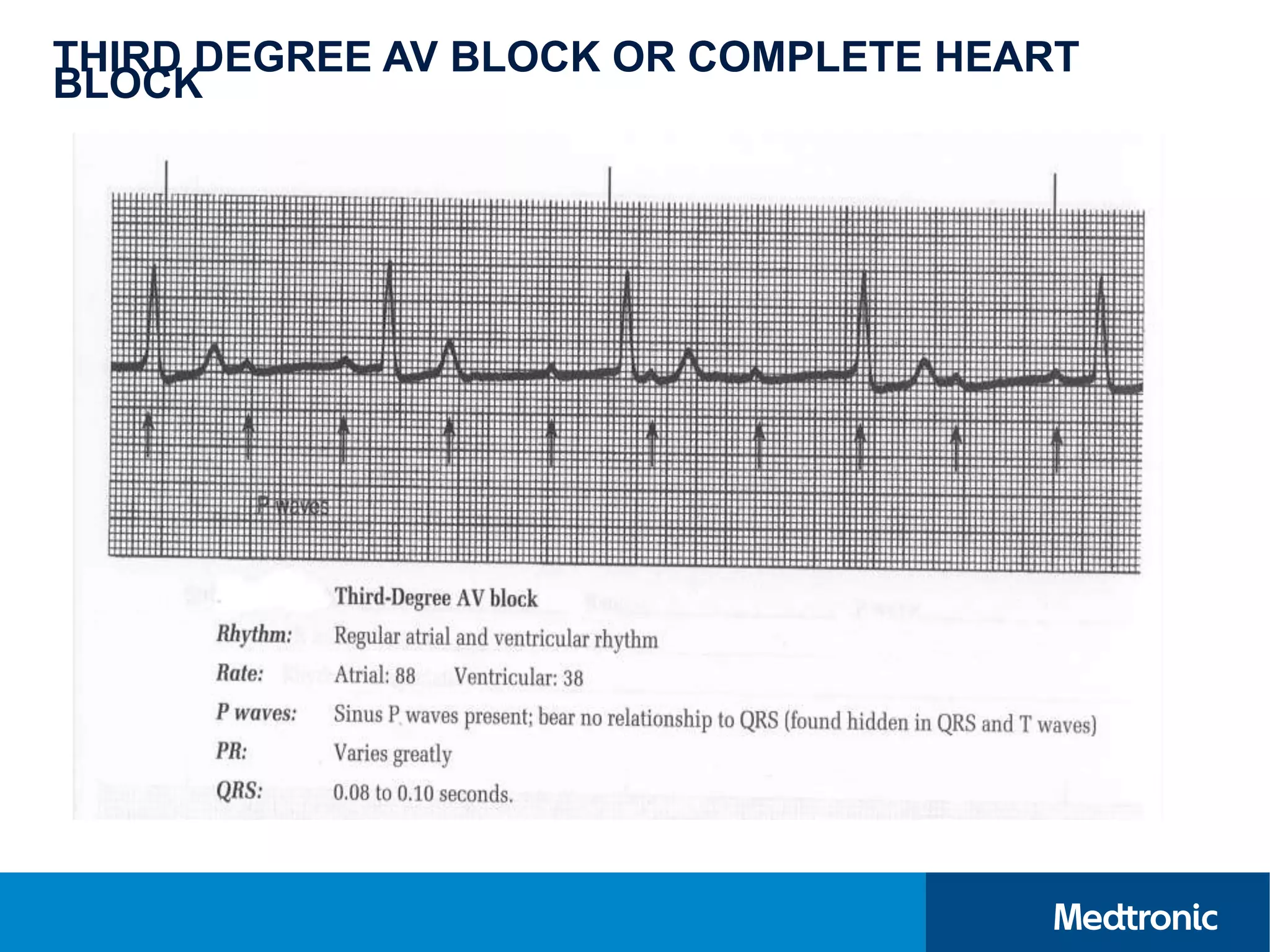 ECG & Intro to Cardiac Arrhythmias.pptx
