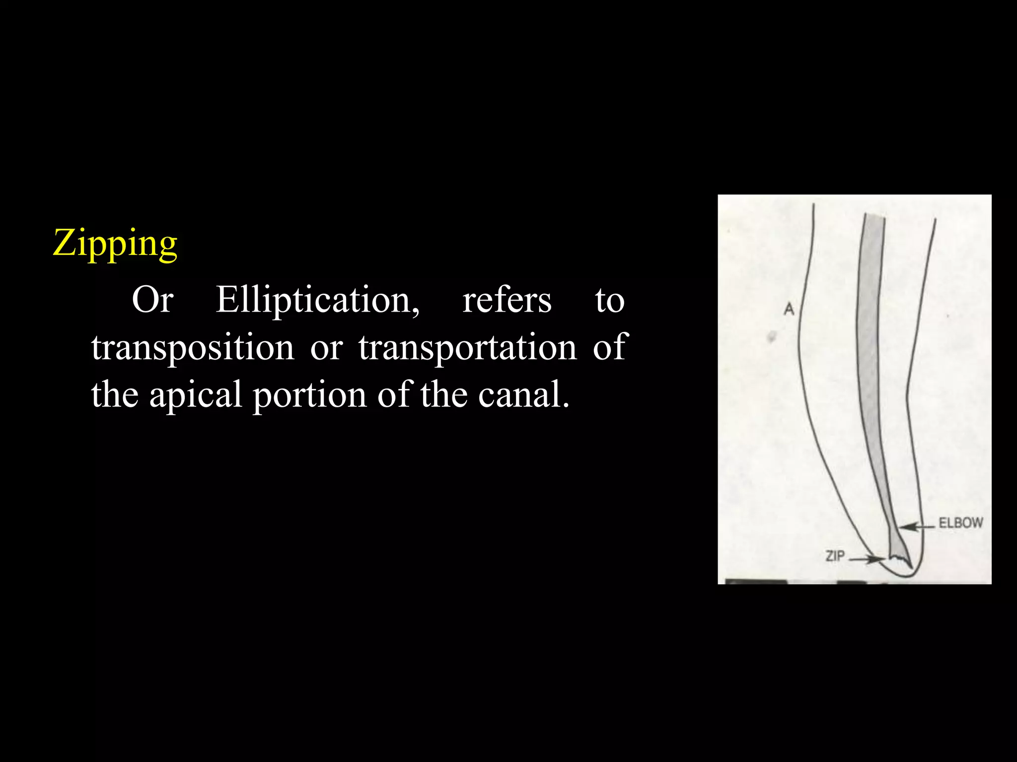2 endodontic mishaps.pptx