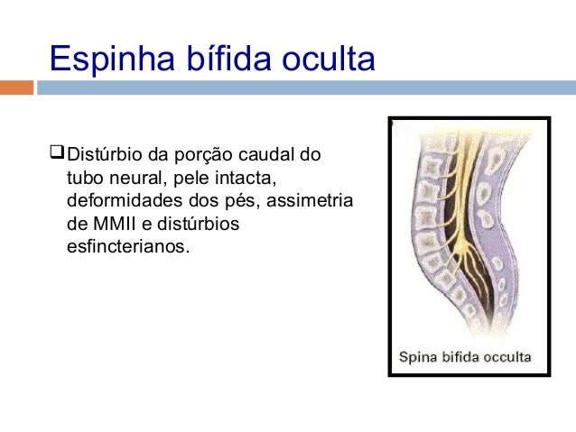 ESPINHA BIFIDA