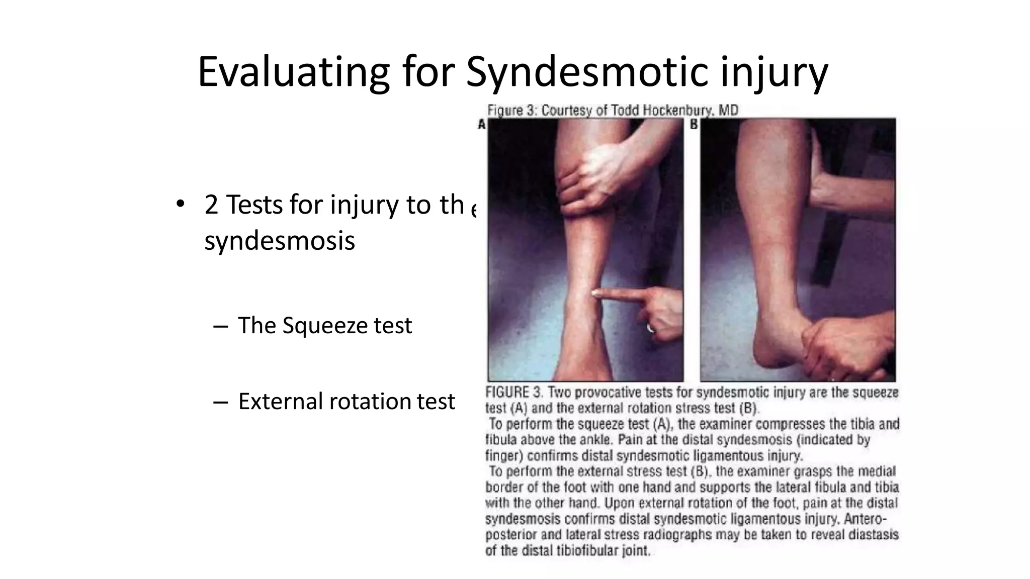 2 Evaluating for Syndesmotic injury.pptx