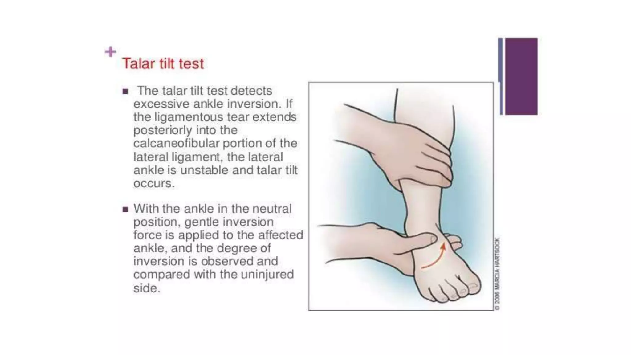 2 Evaluating for Syndesmotic injury.pptx