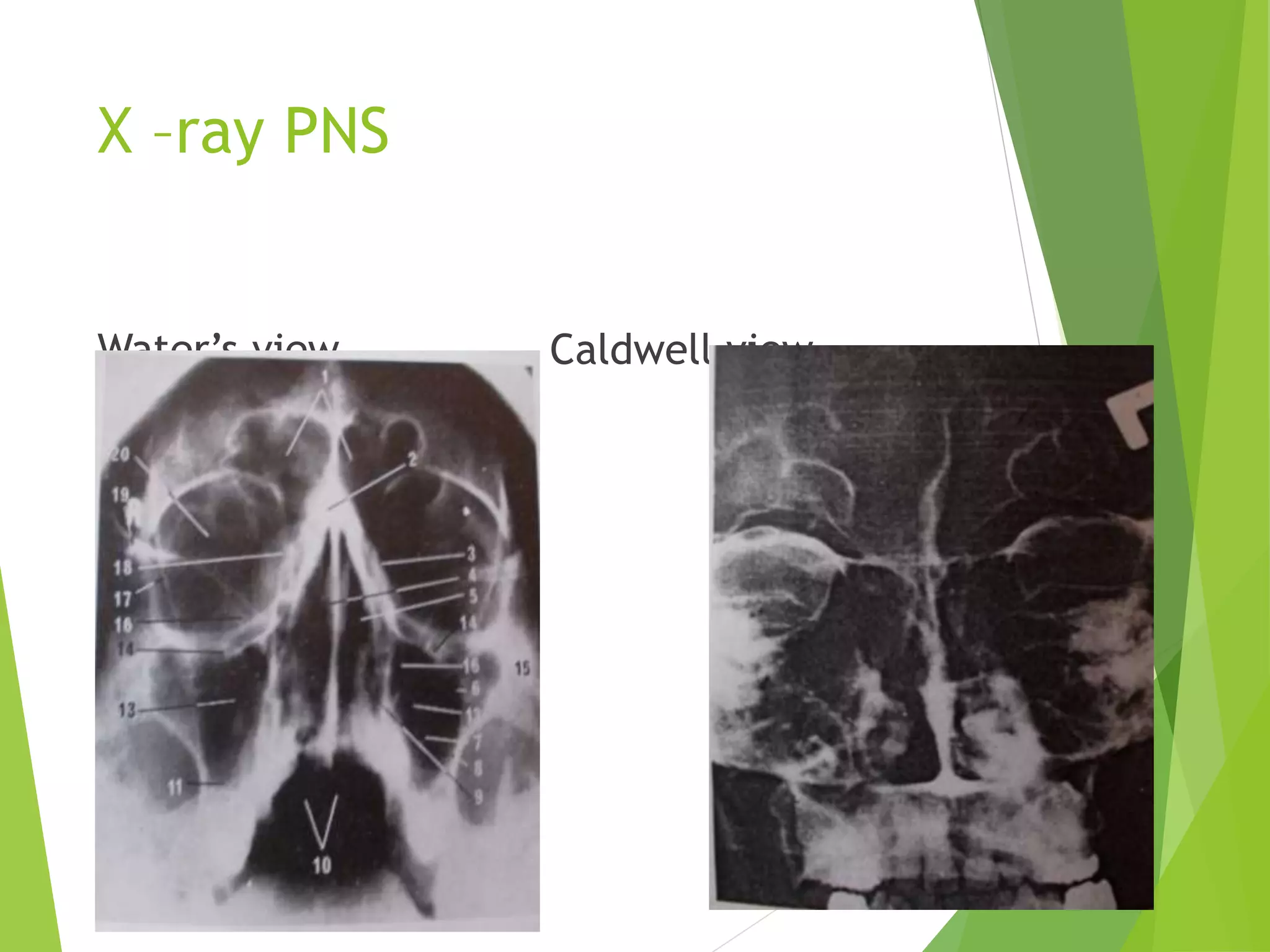 2 examination of nose and pns | PPTX