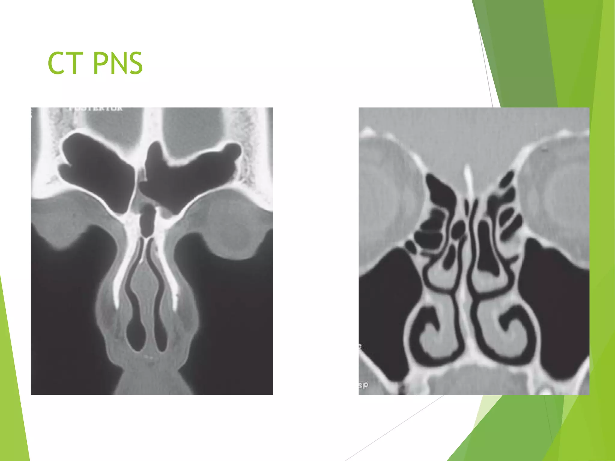 2 examination of nose and pns | PPTX