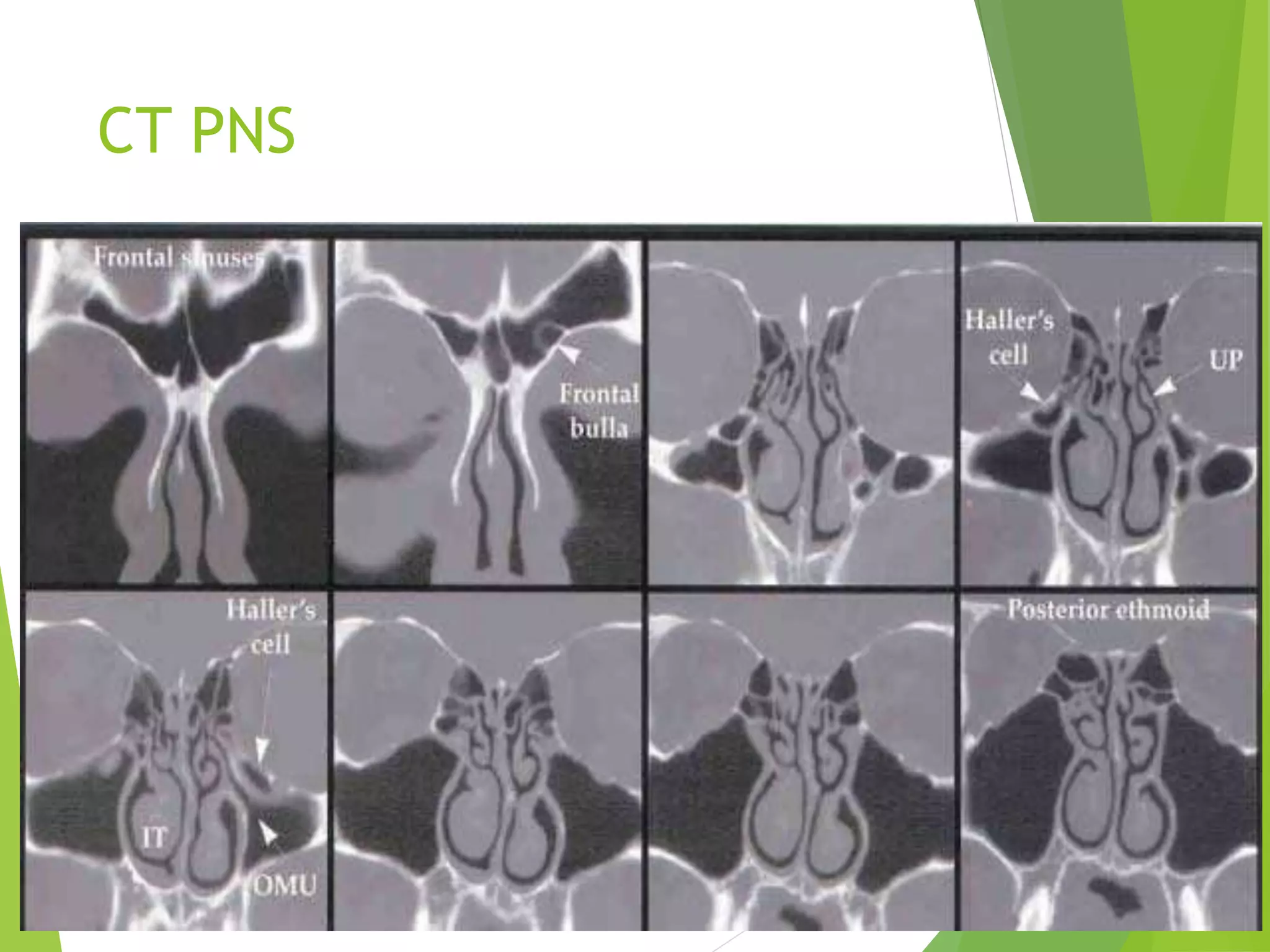 2 examination of nose and pns | PPTX
