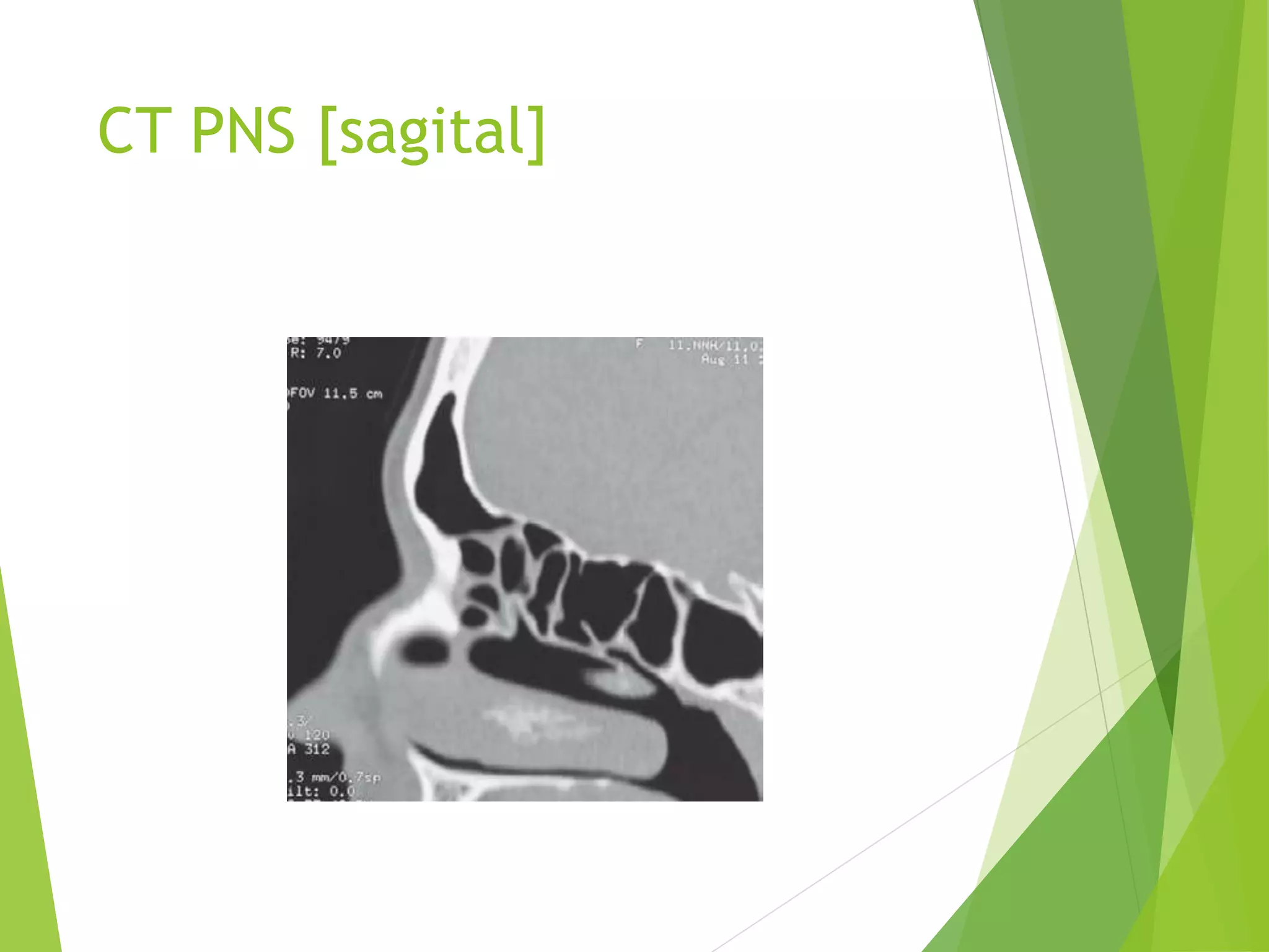 2 examination of nose and pns | PPTX