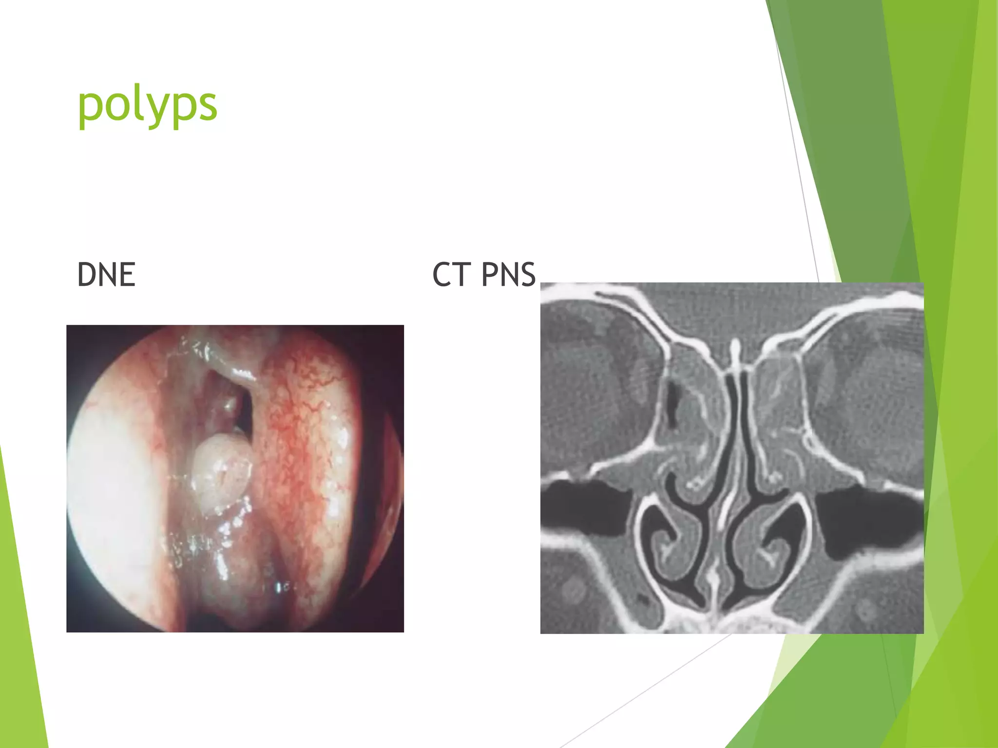 2 examination of nose and pns | PPTX