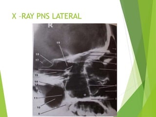 2 examination of nose and pns | PPTX
