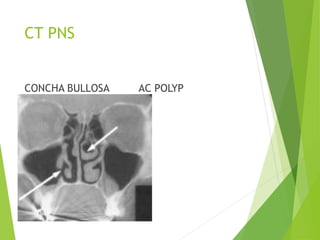 2 examination of nose and pns | PPTX