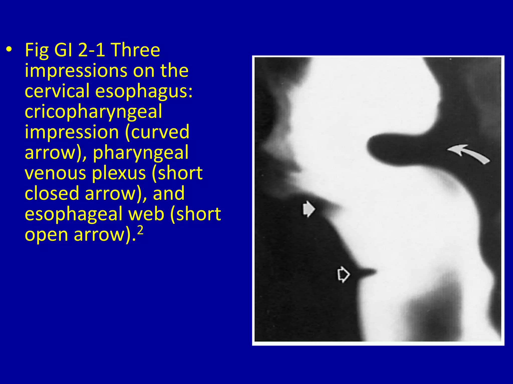 2 extrinsic impressions on the cervical esophagus | PPT