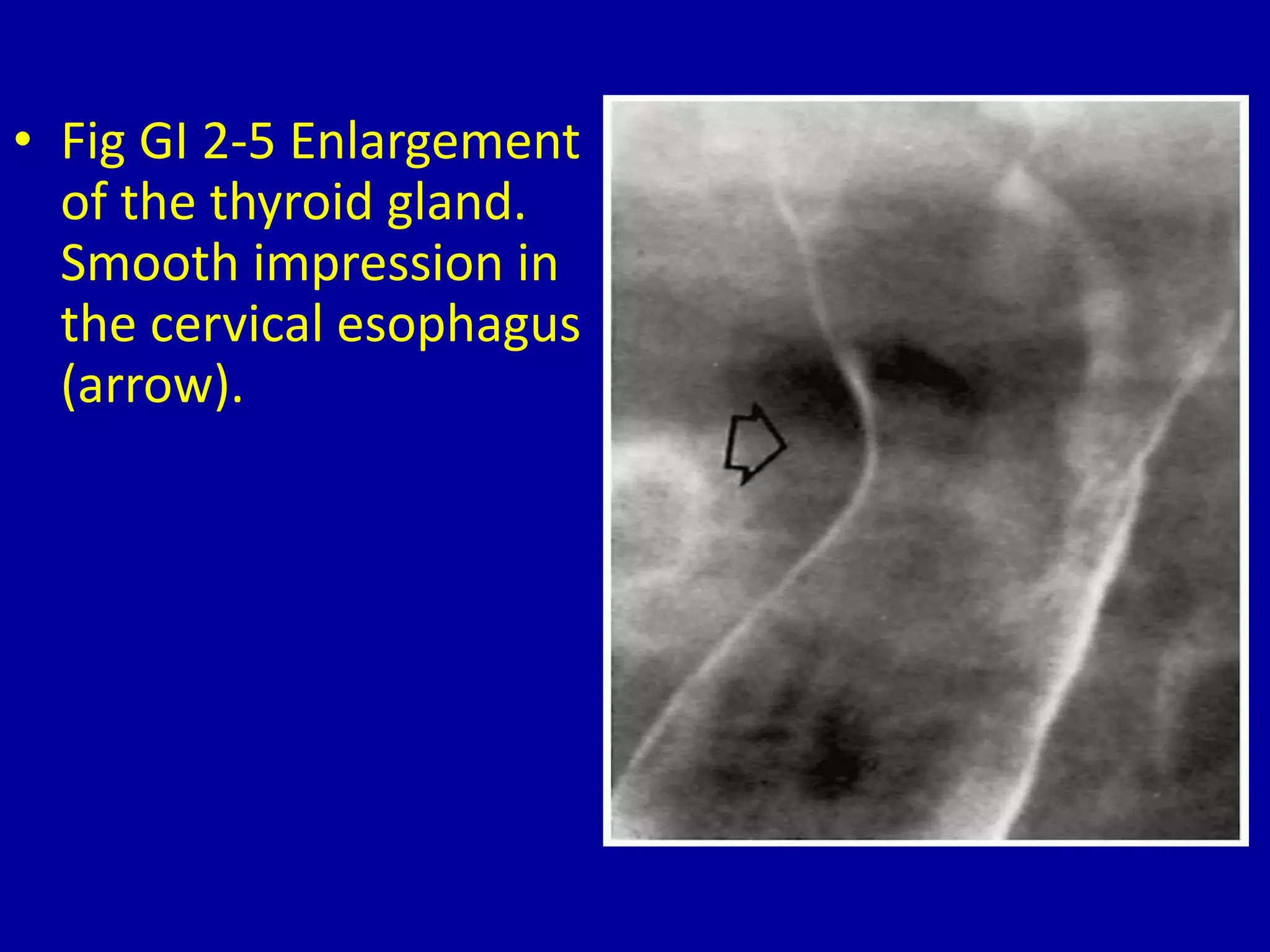 2 extrinsic impressions on the cervical esophagus | PPT